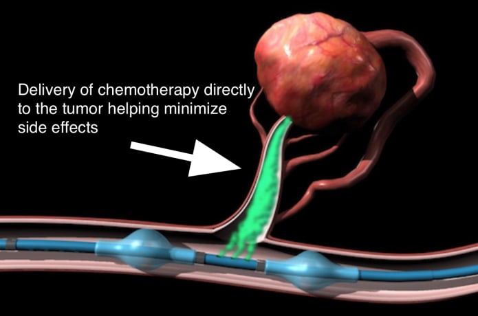 IsoFlow -The Latest in Cancer Treatment Technology | Indiegogo